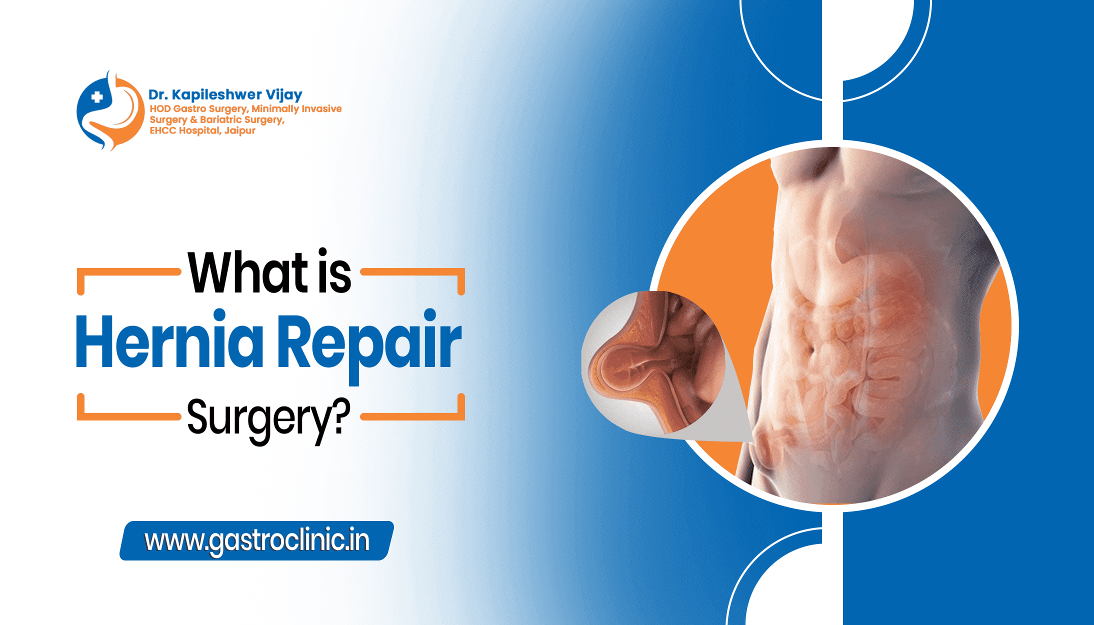 Hernia Hiatal Que Es Y Como Se Cura